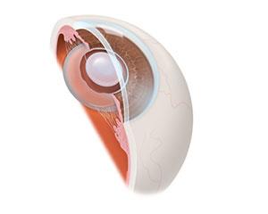 Phakic Intraocular Lenses for Nearsightedness | North Toronto Eyecare
