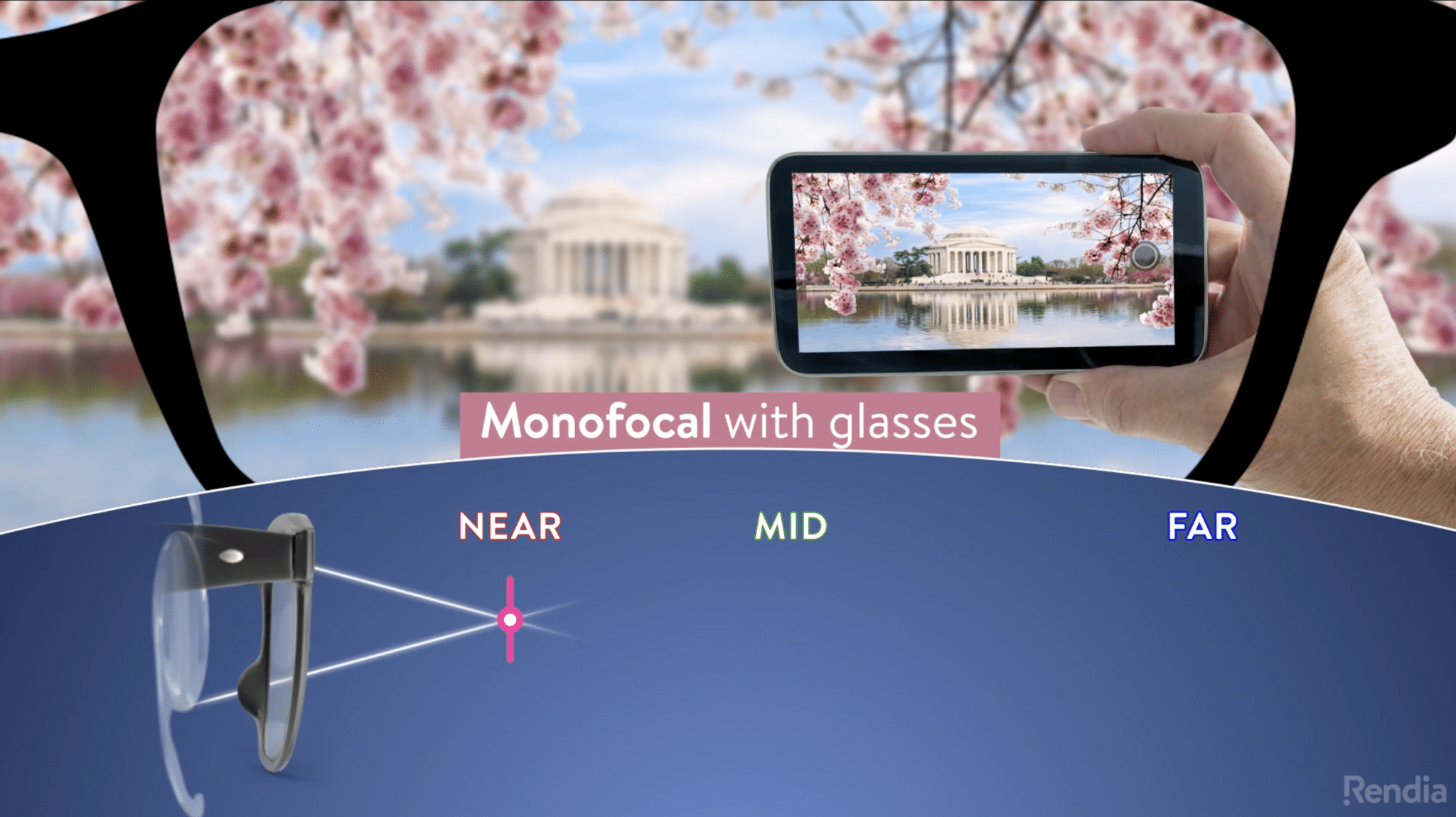 Cataract Surgery Toronto | Premium Lens Implants North York