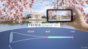 Cataract Surgery Toronto | Premium Lens Implants North York