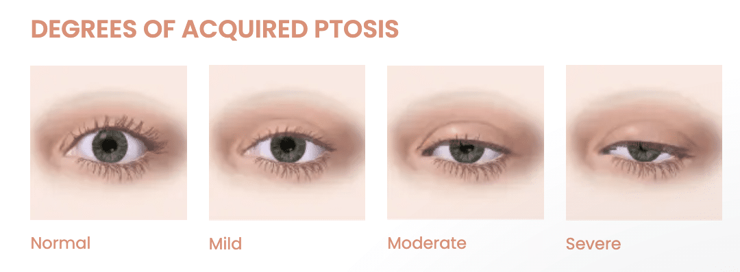 Exploring Solutions for Age-Related Eyelid Droop | North Toronto Eye Care