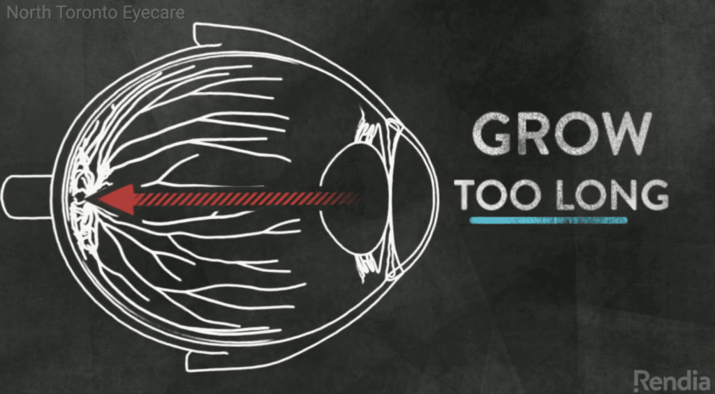 The Real Reason Nearsightedness Is Exploding: 5 Myopia Truths Every ...